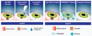 Prokera Long Island | Cornea Care Long Island | Hauppauge Eye Exams